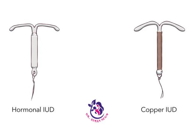 تركيب اللولب بالصور بالخطوات